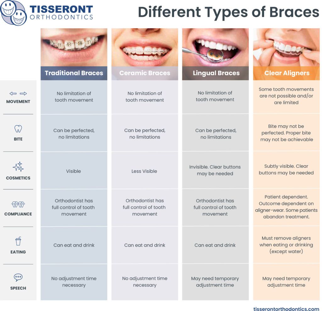 overbite teeth braces duration